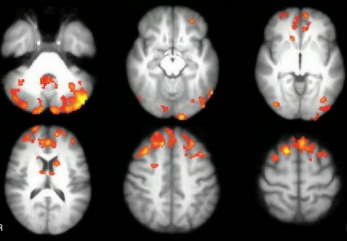 UTRNULOST, BOL, PROBLEMI S OČIMA: Kako prepoznati rane simptome ...